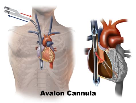 Vv Ecmo — Learnecmo