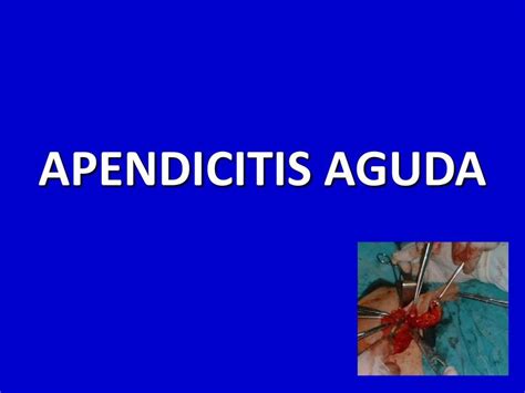 Apendicitis Aguda Udocz