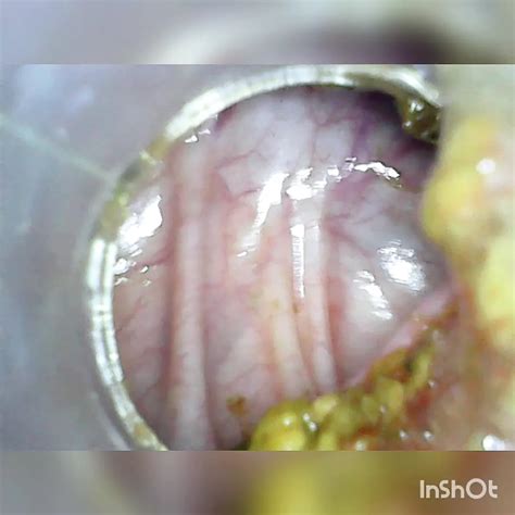 Free Endoscope Porn Videos Xhamster Free Endoscope Porn Videos Xhamster