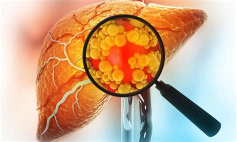 Evotec And Variant Bio Forge Antifibrotic Drug Discovery Partnership