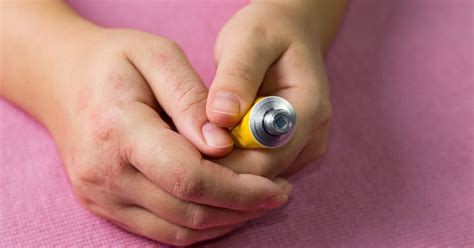 Prescription Therapies For Pediatric Atopic Dermatitis Sharecare
