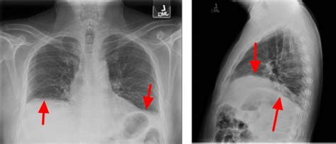Atelectasis Causes Symptoms Atelectasis Treatment Atelectasis Causes Symptoms Atelectasis Treatment