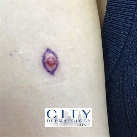 Cherry Angioma Removal In London From £275 Same Day Treatment