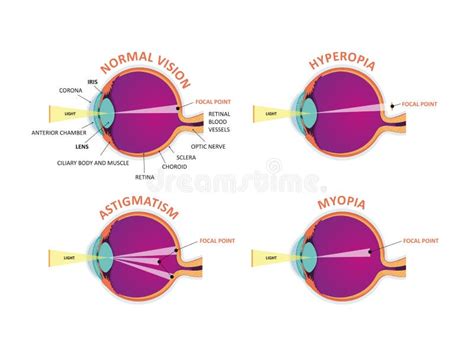 Vision Defects Myopia Astigmatism Stock Illustrations 8 Vision