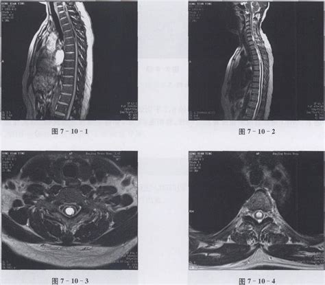 脊髓空洞症 磁共振成像读片中枢神经 医学