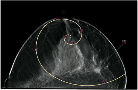 Golden Ratio Φ Breast Cancer Detection And Fibonacci Sequence Download Scientific Diagram
