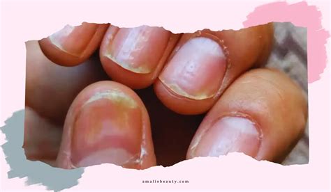 Nail Pitting How Can It Be Recognized And Treated