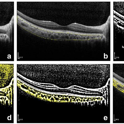 image binarization for choroid with niblack auto local thresholding