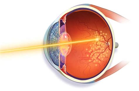 Biaya Laser Retina Prp Di Klinik Mata Kmu Hanya 1juta An