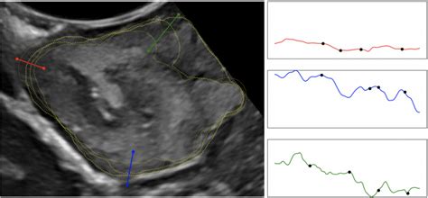 논문 리뷰 Confidence Based Annotation Of Brain Tumours In Ultrasound