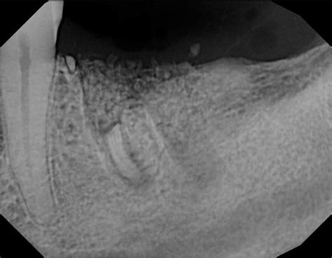 Ensuring Complete Tooth Removal In Complicated Extractions Cases And