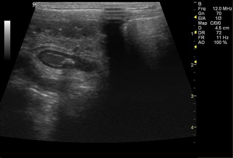 What Does Appendicitis Look Like On Ultrasound At Aurelia Dion Blog