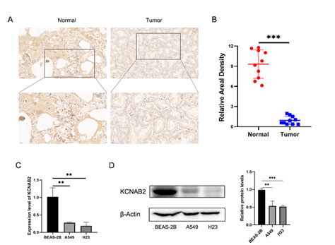 Validation Of The Decreased Expression Of Kcnab2 In Luad Using Clinical