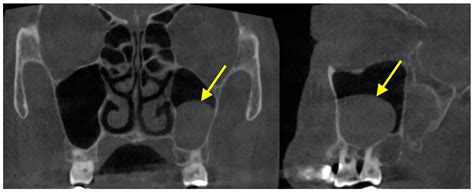 Maxillary Sinus Ostium Radiology At Sarah Scoggins Blog