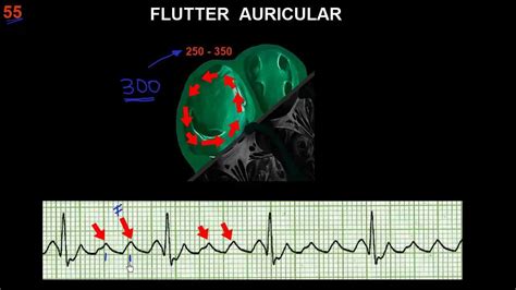 curso de electrocardiografia 55 flutter y fibrilaciÓn auriculares youtube