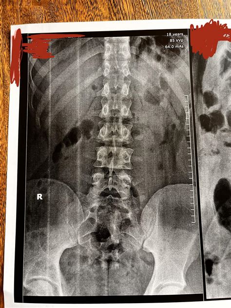 Is This Curvature Normal R Xrays