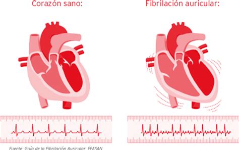 Electrocardiograma Con Fibrilación Auricular