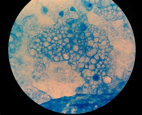 Acid Fast Bacilli Positive Red Cells Stock Image Image Of Microscopy