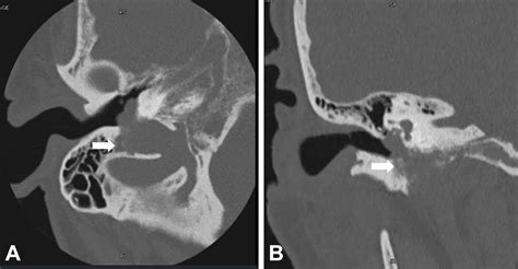 Facial Paresis And Pulsatile Middle Ear Mass Betzamel Lopez James G