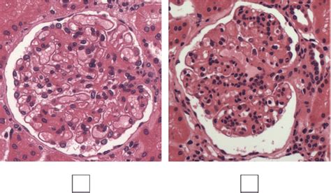 Classification Of Glomerular Hypercellularity Using Convolutional Features And Support Vector