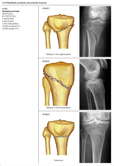 Fractures Of The Tibiafibula Musculoskeletal Key Fractures Of The Tibiafibula Musculoskeletal Key