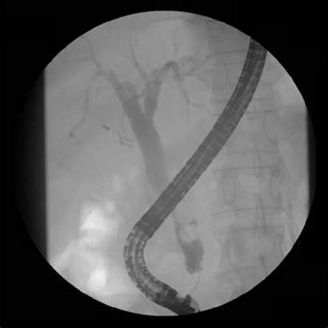 Endoscopic Retrograde Cholangiography Showing Dilatation Of The Common Download Scientific