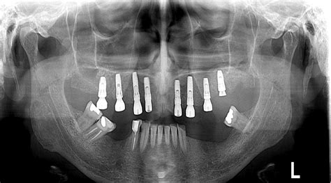 Tooth Instance Segmentation Pick Pic Instance Segmentation Dataset By