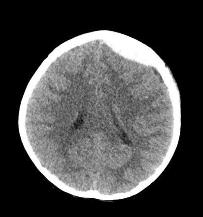 Intracerebral Hemorrhage Icd
