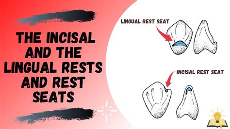Types Of Occlusal Rest At James Earle Blog
