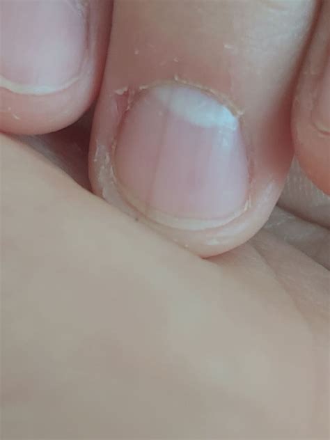 손톱 검은색 세로줄 지식in