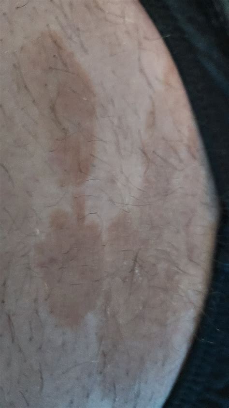 Brown Spots In Groin Area Rgermanshepherds