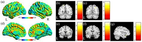 Connectome Analysis Of Brain Functional Network Alterations In