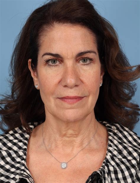 Facial Fat Grafting Before And After 02 Core Plastic Surgery