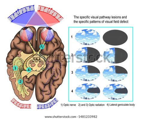 Patterns Visual Field Defect Which Represent Stock Illustration Shutterstock