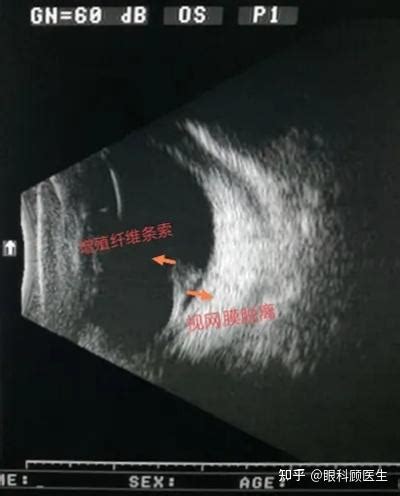 什么是永存原始玻璃体增生症 知乎