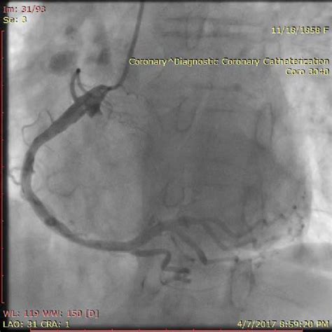 Total Occlusion Of The Lcx In The Proximal Segment Download Scientific Diagram