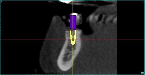 Dental Ct Scans And Bone Width For Implants Burbank Implant Expert