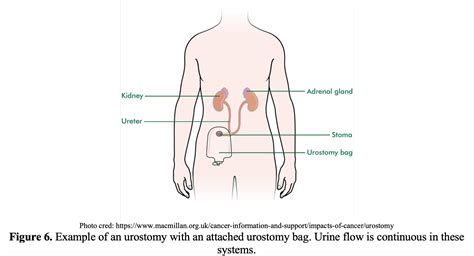 Ostomy Complications ED Presentations Complications And Management EmDocs