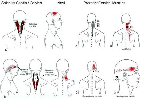 Trigger Point A Trigger Points Trigger Myofascial Release