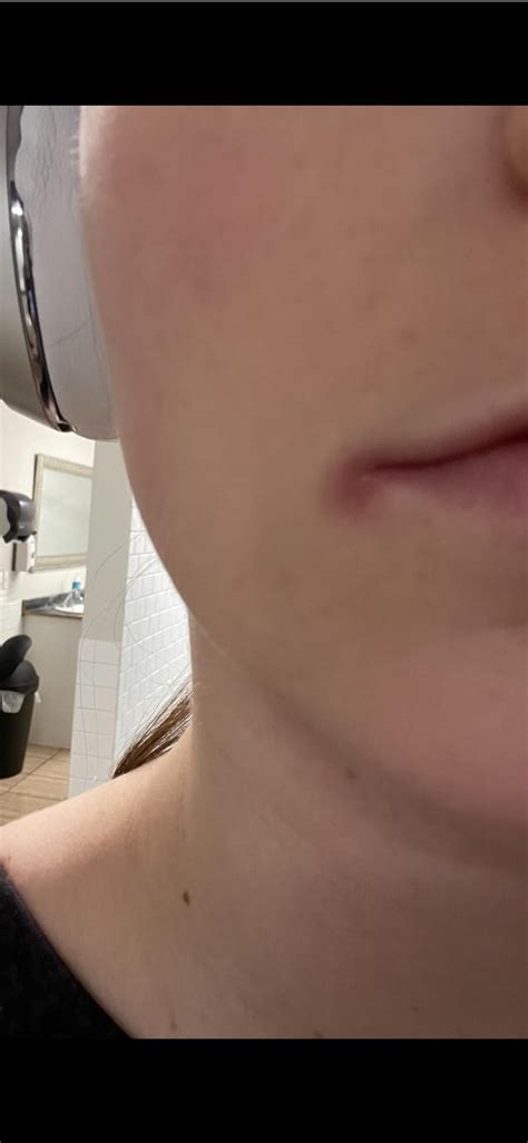 Angular Cheilitis Help Feeling Defeated R Dermatologyquestions