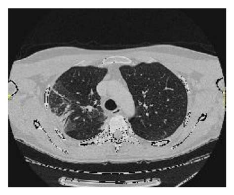 Hr Ct Lung Pretreatment Interstitial Consolidation With Centrilobular