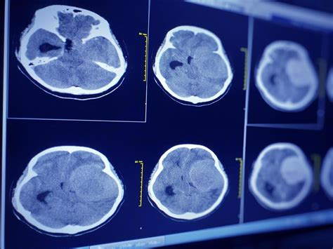 Ct Brain Seven Cm Diameter Hyperdensity Mass With Lobulated Surface At Extra Axial Lateral To