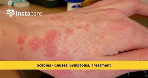 Scabies Symptoms Causes Treatment Options Remedies And Prevention Tips