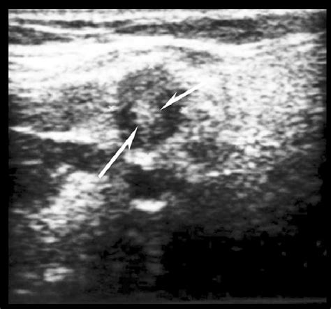 Us Shows Markedly Hypoechoic Lymph Node With Hyperechoic Punctuate Download Scientific Diagram