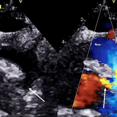 A Double Aortic Arch And Atretic Left Arch In A 1 Year Old Boy A An
