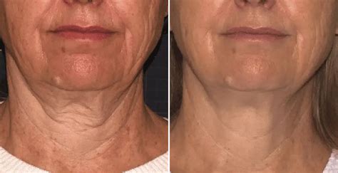 Sofwave Nyc Skin Tightening Therapy Manhattan Skinney Medspa