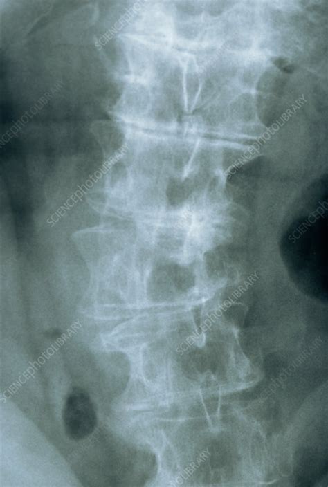 Osteoarthritis Lumbar Spine X Ray At Crystal Molden Blog
