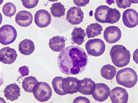 Wbc Inclusion Bodies