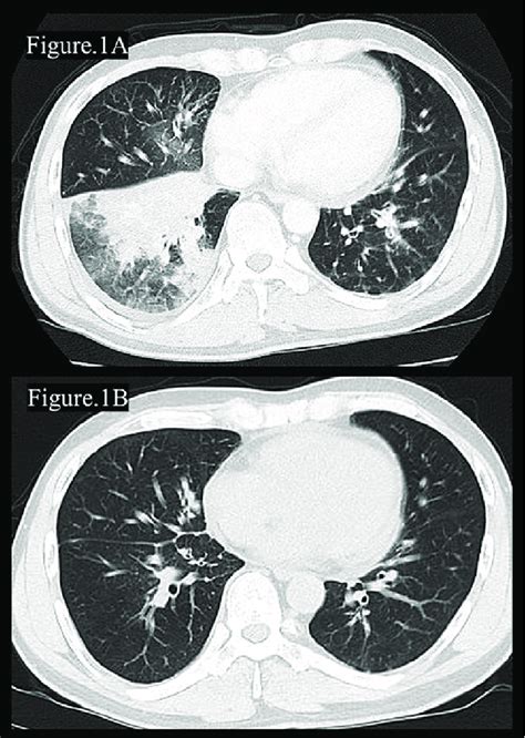 A Computed Tomography Scan On Admission Showed Infiltration And