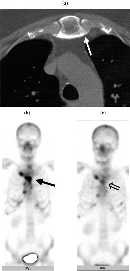 A Axial Ct Scan Of The Sternal Region Reveals Marked Hyperostosis And Download Scientific